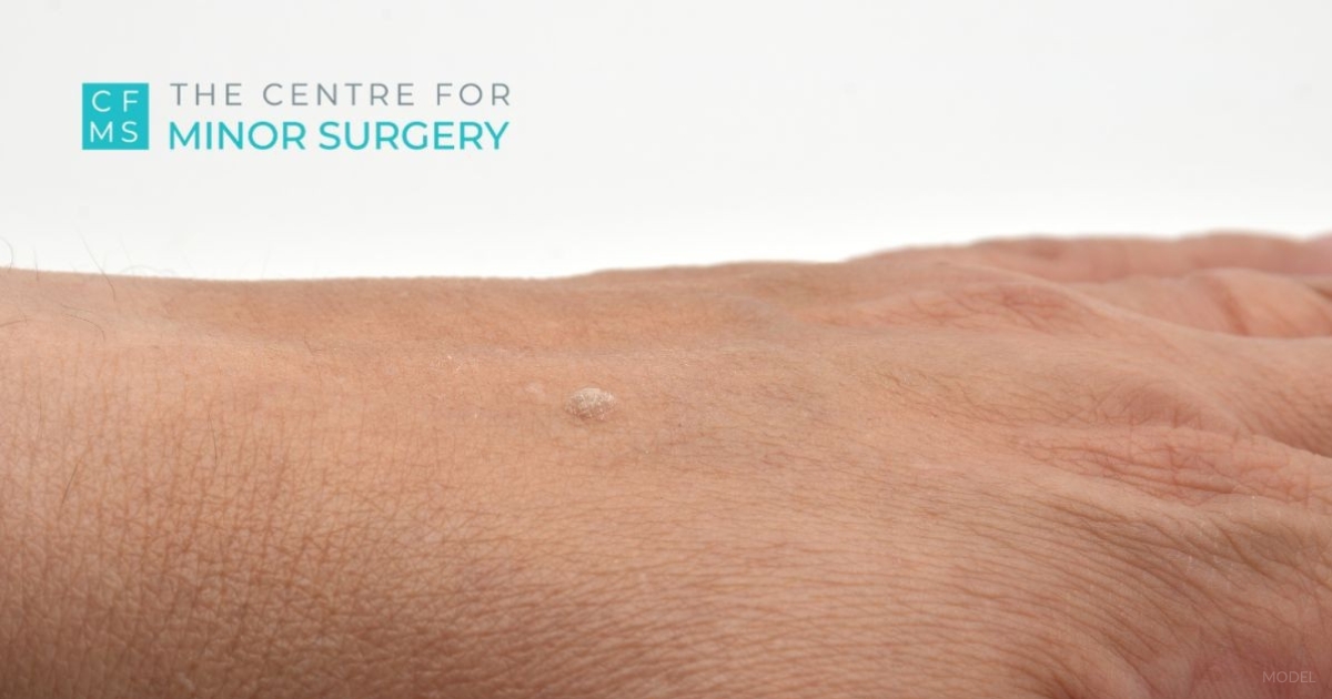 What Causes a Sebaceous Cyst? – Centre for Minor Surgery